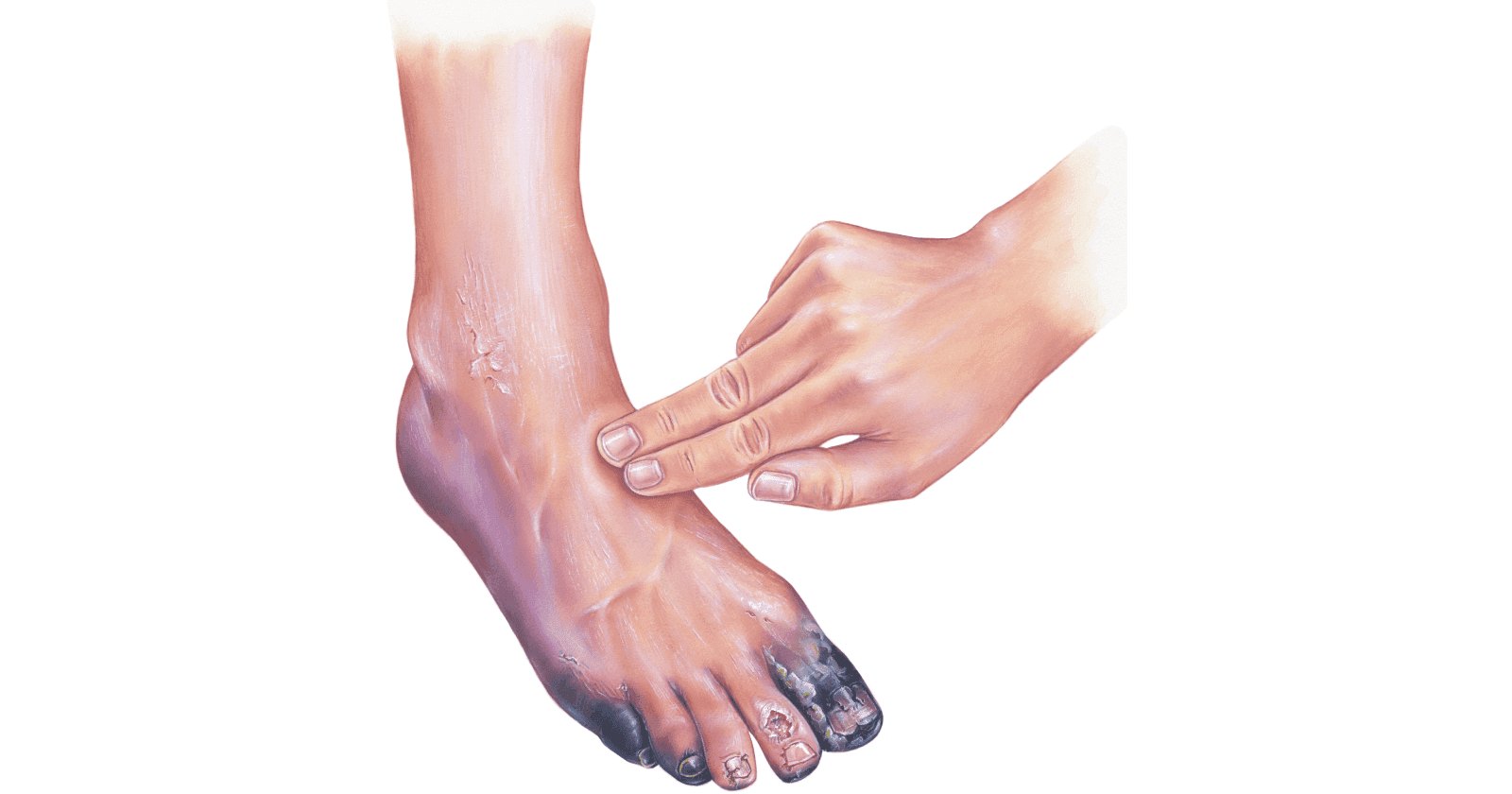 Gangrene: Symptoms, Causes, Prevention and Treatments