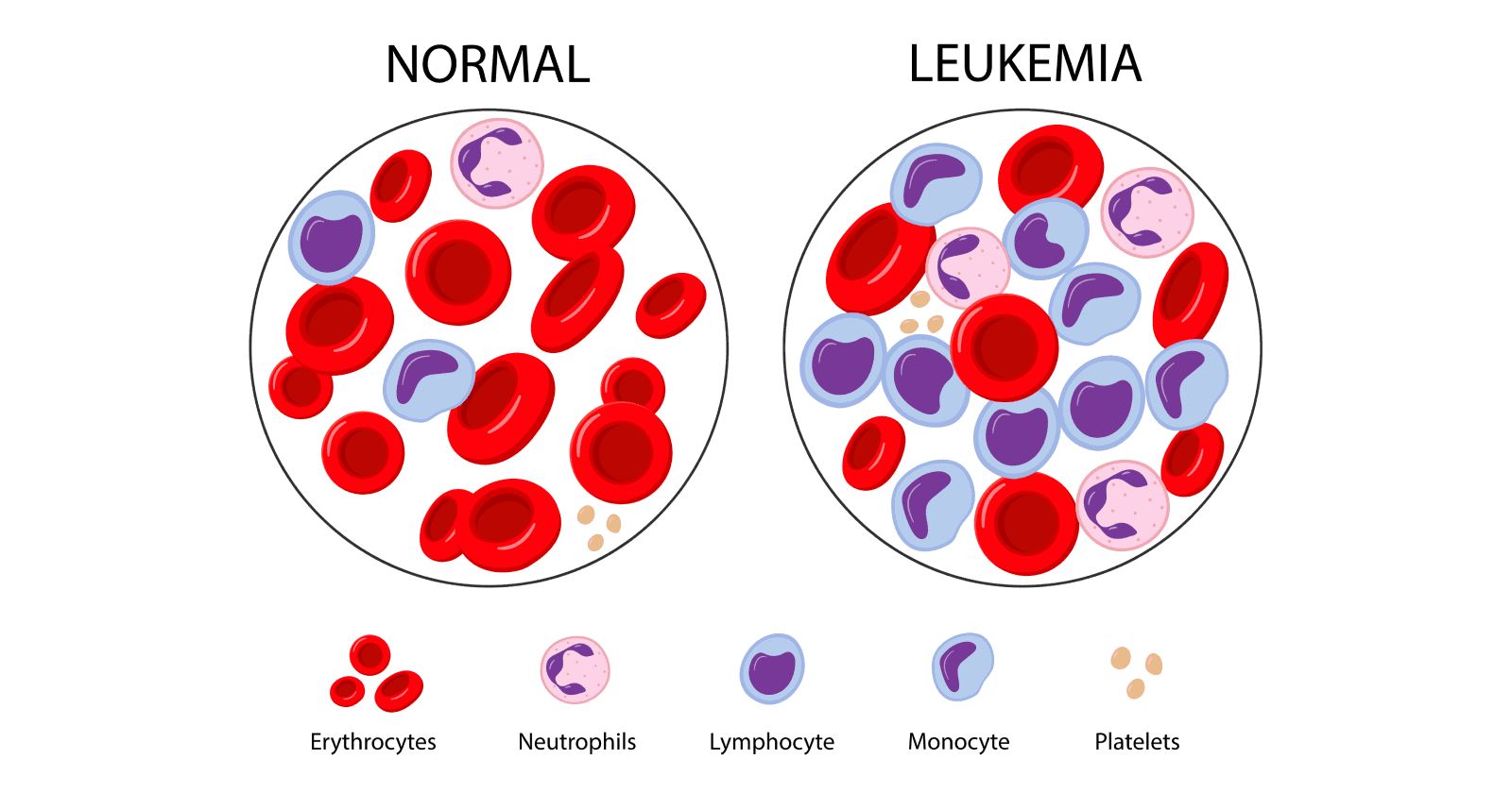 Leukemia Cancer Cells