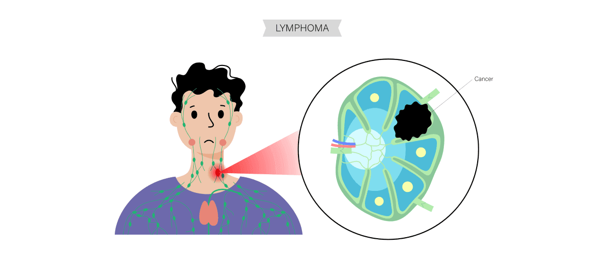 Lymphoma Cancer: Symptoms, Causes, Types and Treatment