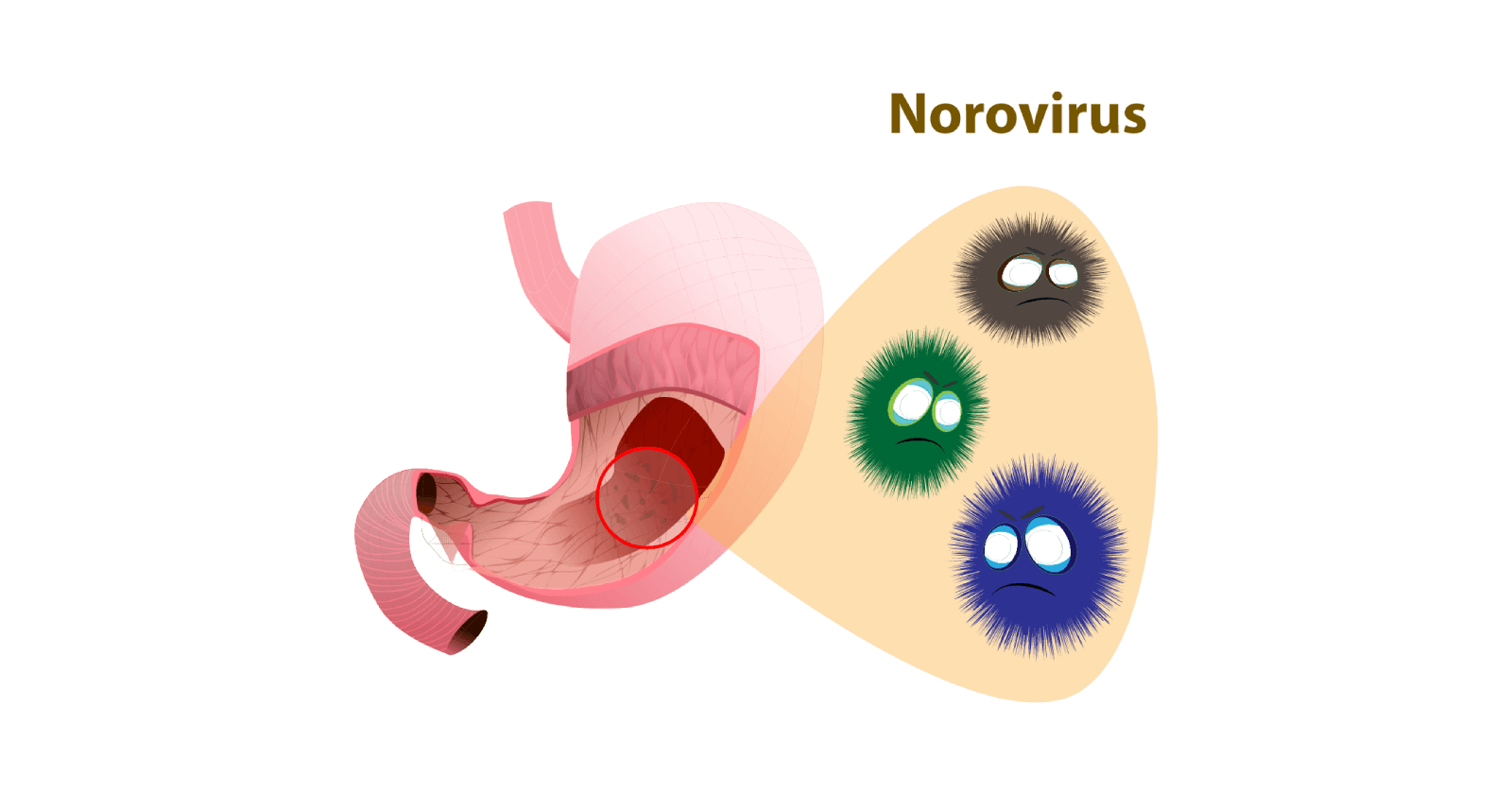 Norovirus Infections And Children Symptoms And Treatment