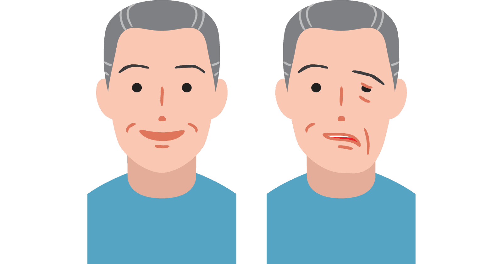 Paralysis: Symptoms, Types, Causes, Prevention and Treatment