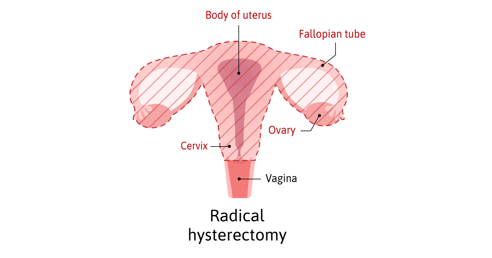 Uterus Radical Hysterectomy Beautiful Cervix Project The Practice Of