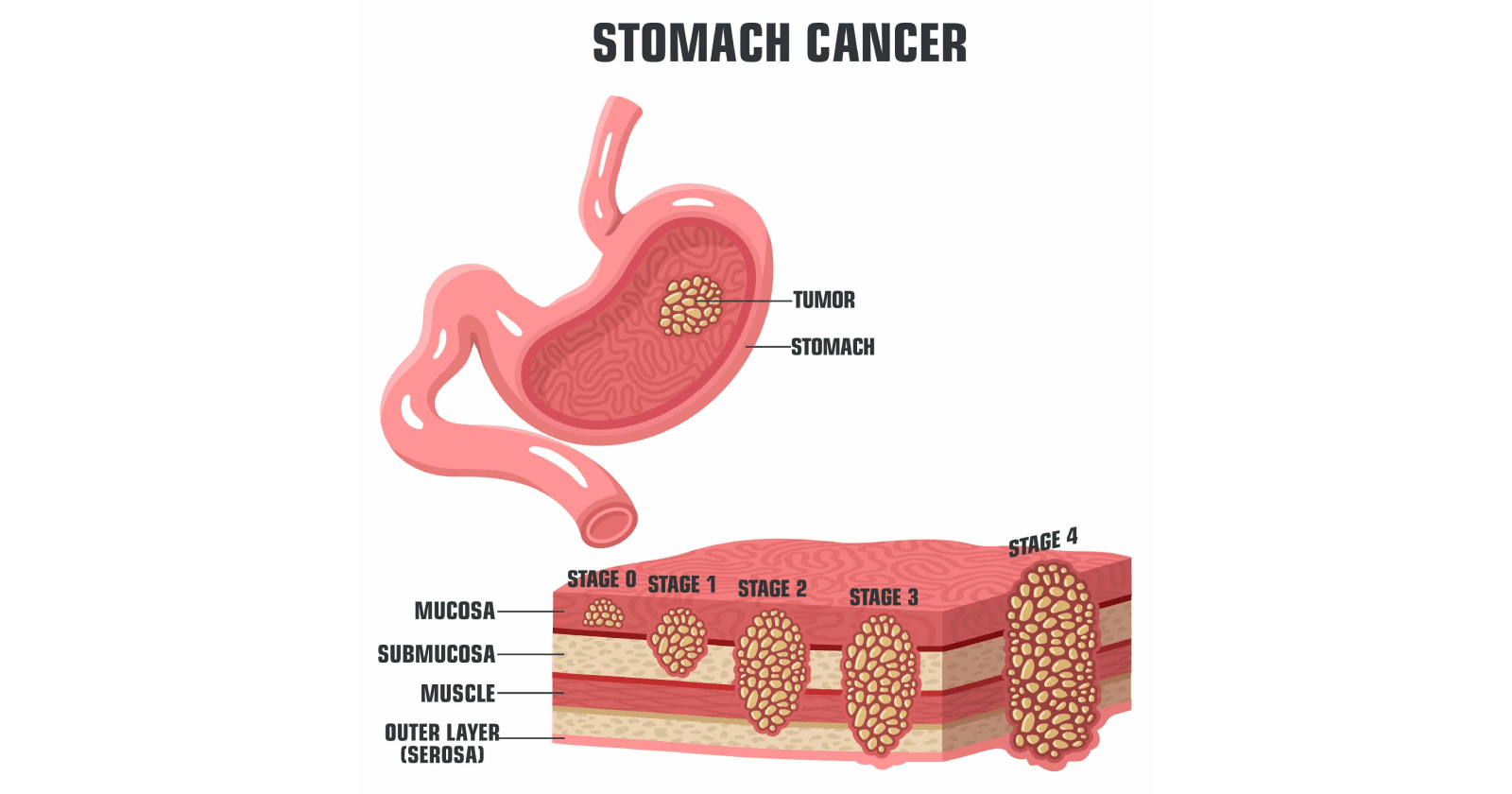 End Stage Stomach Cancer Timeline, Symptoms, And Care – WTQM