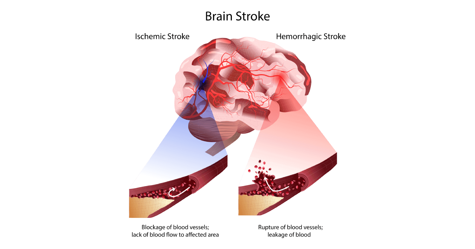 Stroke or Brain Attack: Types, Symptoms, Causes, Prevention & Treatments