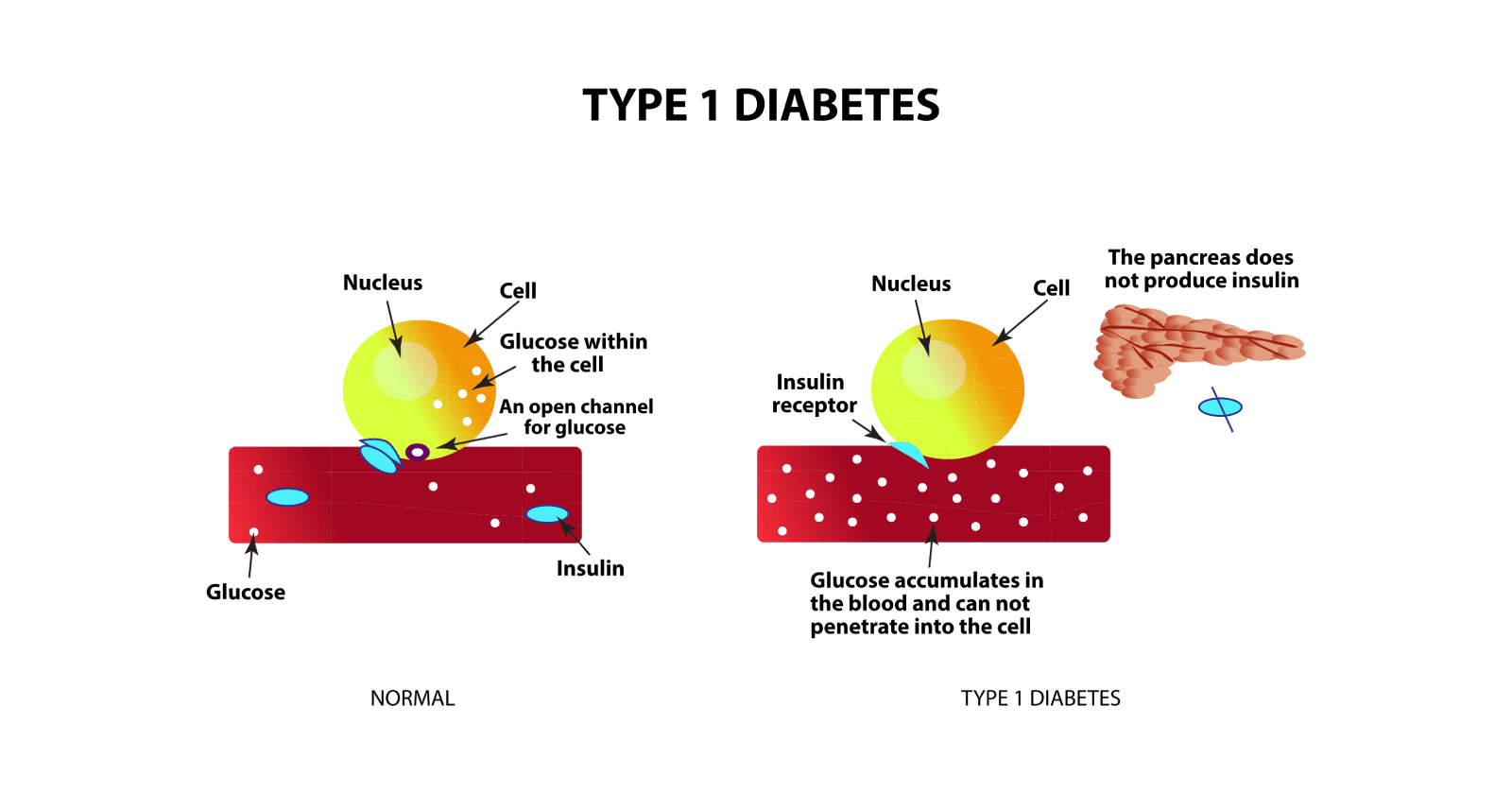 Type 1 Diabetes: Symptoms, Causes And Treatment