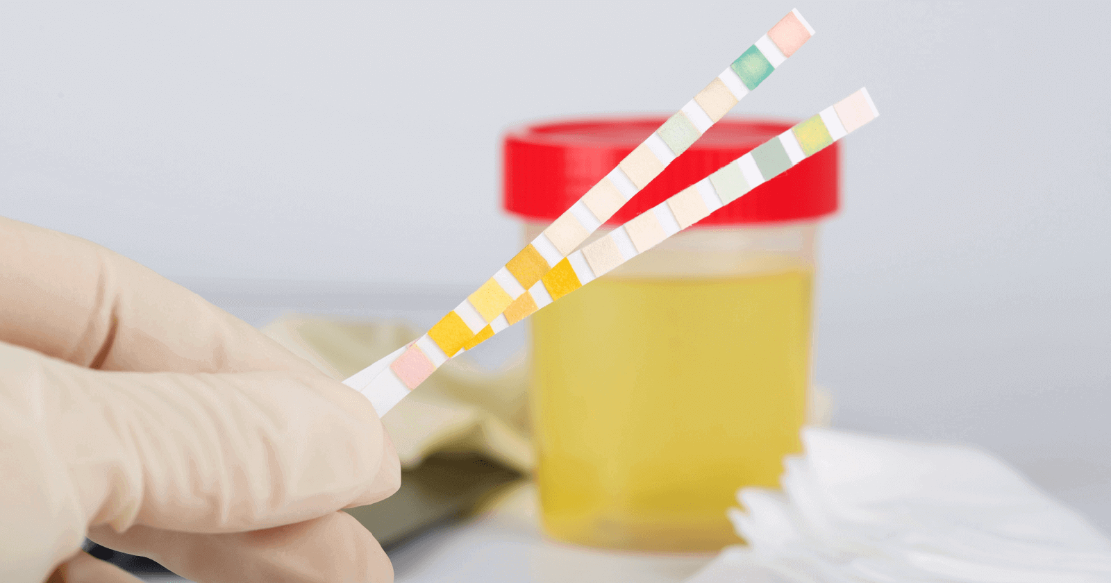 Urine Odour: Meaning, Symptoms, Causes & Treatment