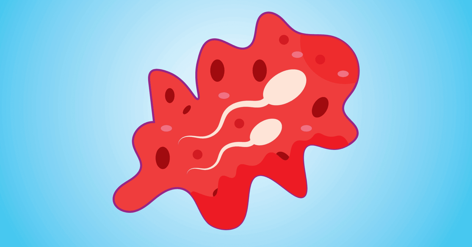 Blood in Semen (Hematospermia): Causes & Treatment