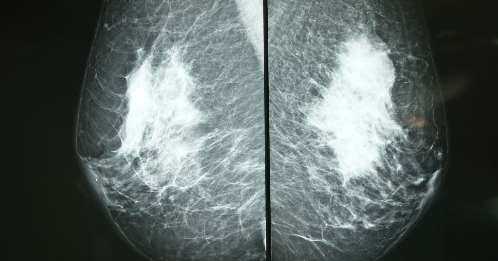 Breast Calcifications: Meaning, Symptoms, Causes & Treatment