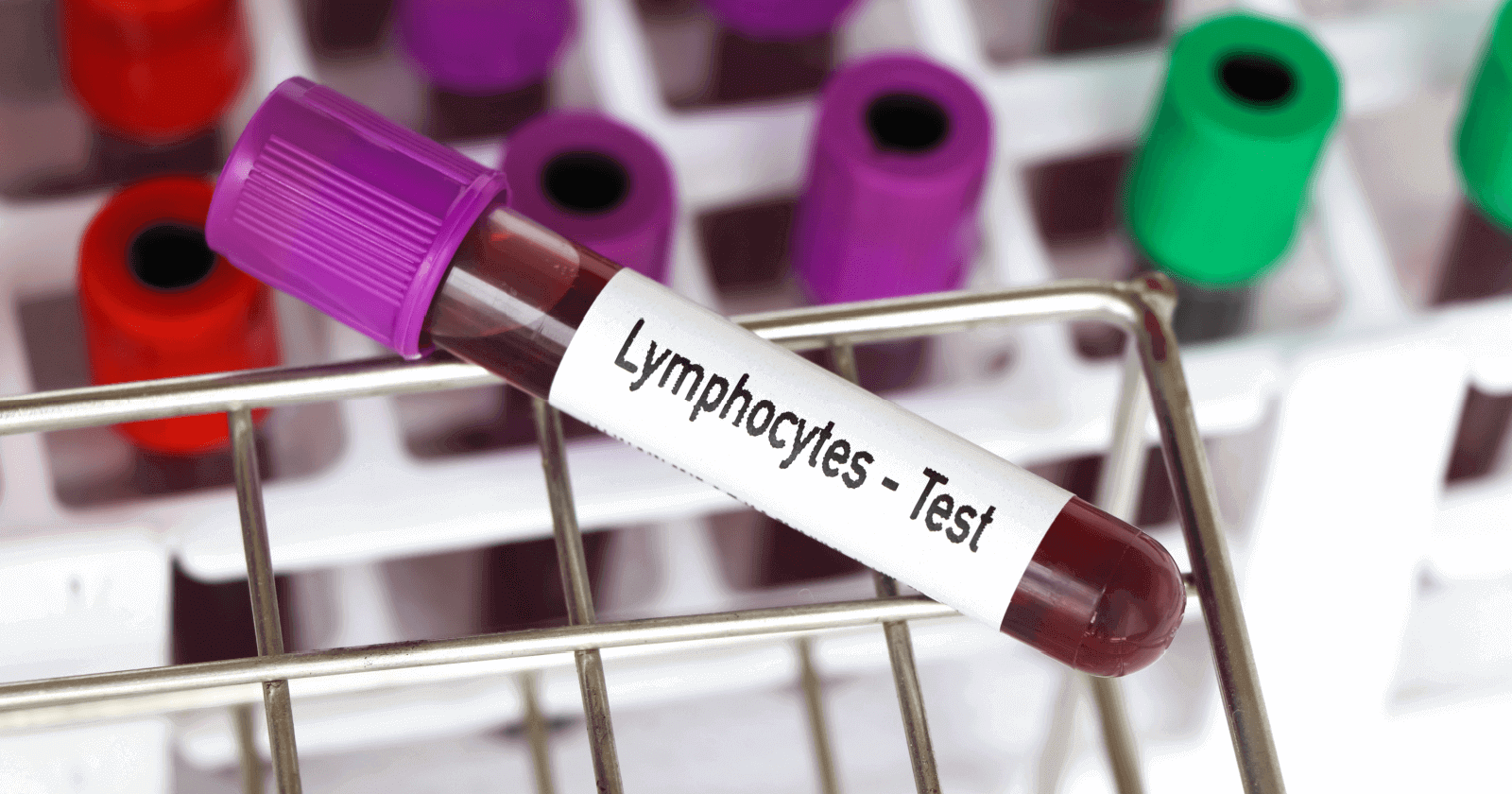 Lymphocytosis (High Lymphocyte Count): Symptoms, Causes & Diagnosis