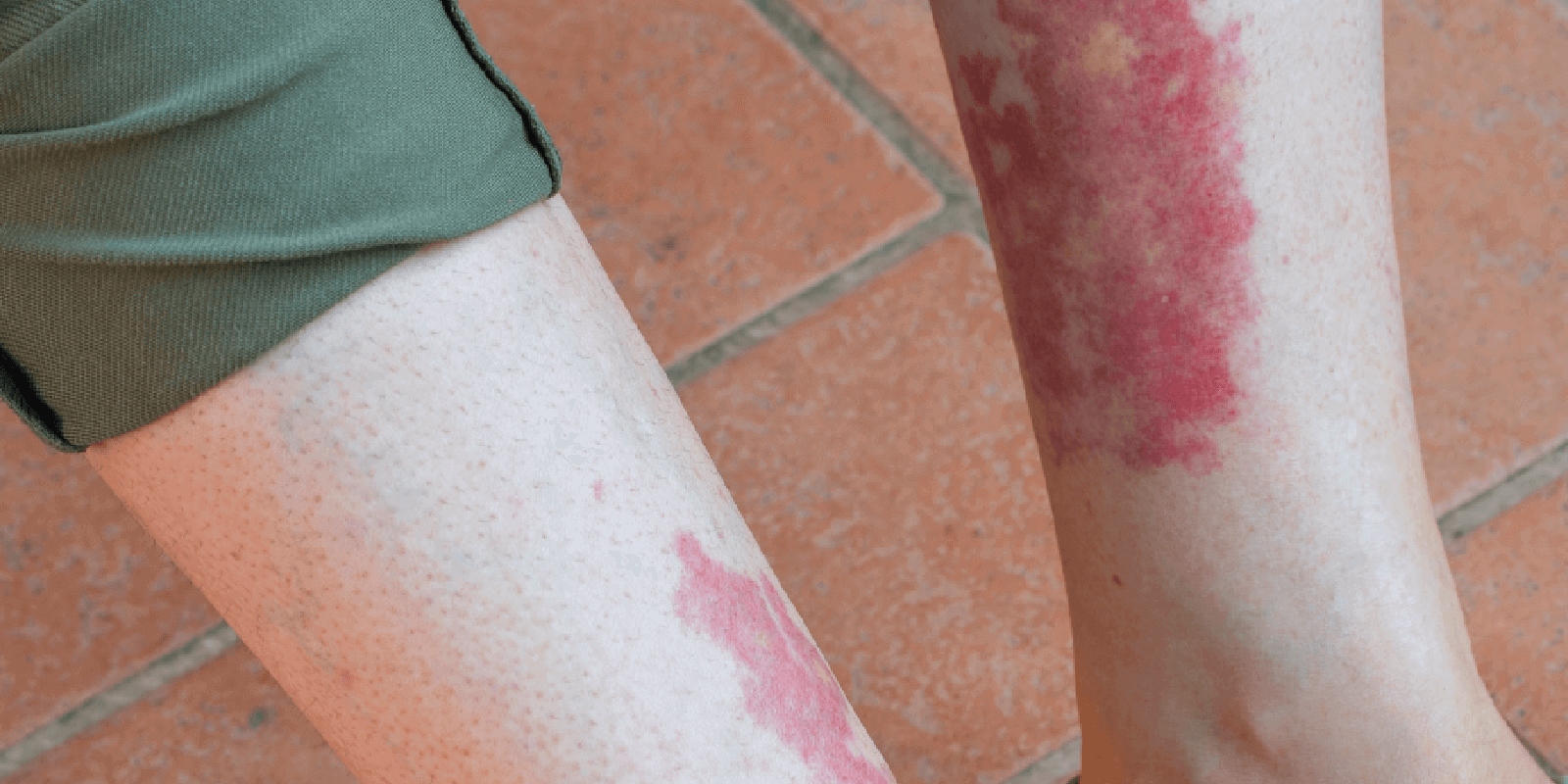 Vasculitis (VCS): Symptoms, Causes, Types, Diagnosis & Treatments
